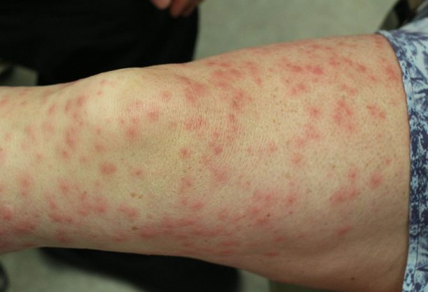 Rubella in Pregnancy – Reasons, Symptoms & Treatment