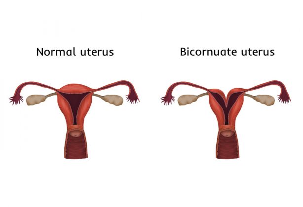 Bicornuate Uterus – Reasons, Signs & Treatment