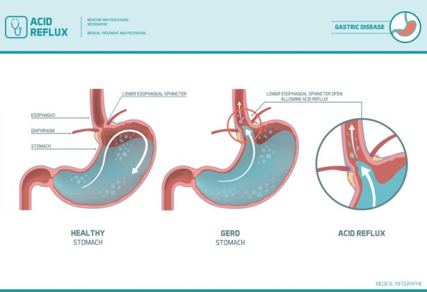 Digestive Problems in Infants