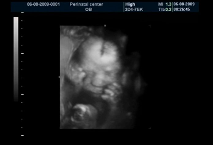 If your pregnancy is uncomplicated till now then you will not need to ...