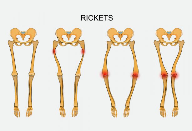 Rickets in Kids - Reasons, Signs, Diagnosis & Remedies