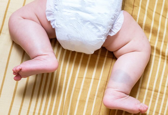 Birthmarks in Babies - Types, Causes & Treatment