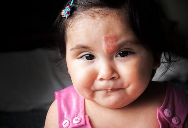 Birthmarks in Babies - Types, Causes & Treatment