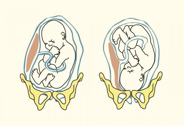 External Cephalic Version(ECV) : Procedure, Risks & Success Rate