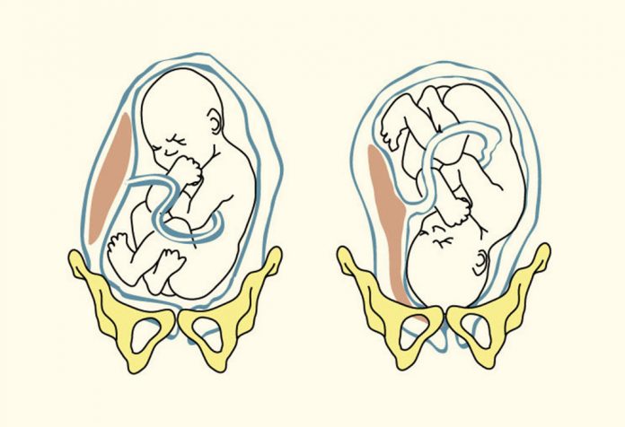 External Cephalic Version(ECV) : Procedure, Risks & Success Rate
