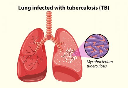 What Is Tuberculosis?