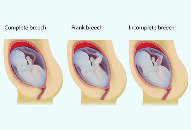 10. Breech Pregnancy