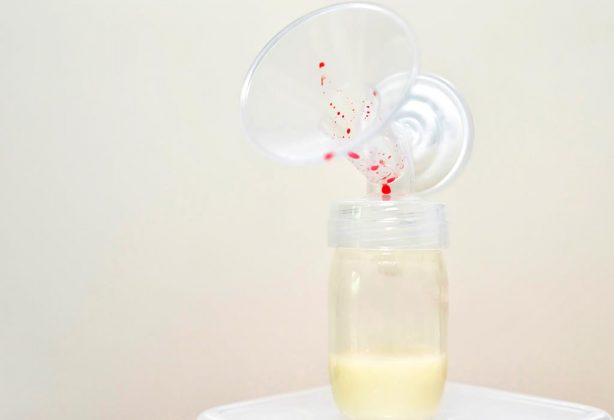 Blood in Breast Milk: Is It Safe, Causes & Treatment