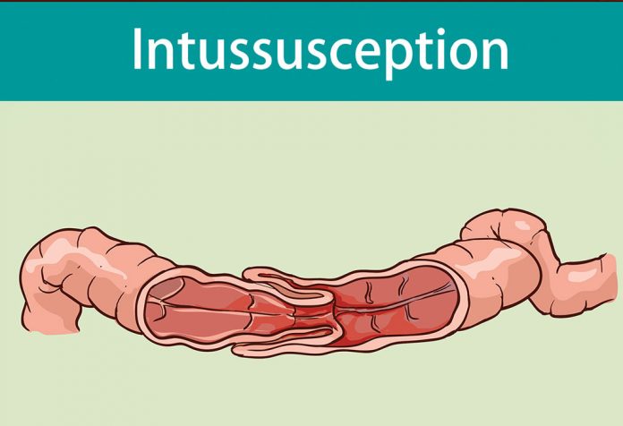 Complications of Intussusception