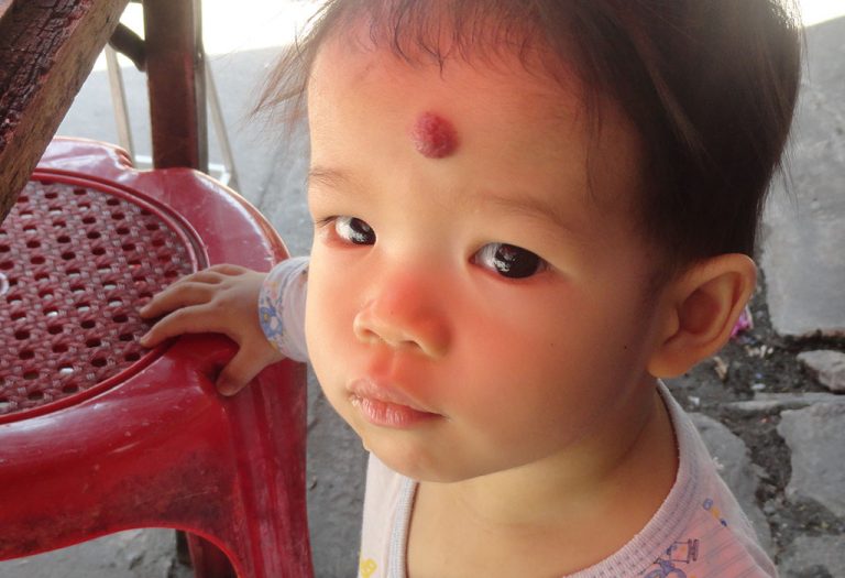 Salmon Patch (Stork Bites or Angel Kisses) Birthmarks in Newborn Baby