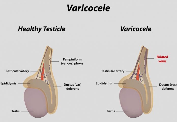 đ Varicocele E Infertilidad