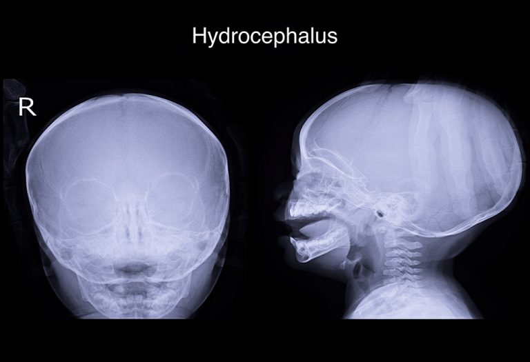 Hydrocephalus in Babies - Causes, Signs & Treatment
