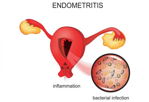 C-Section Scar Infection - Types, Reasons, Signs & Treatment