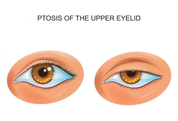 10 Common Eye Problems in Children and Their Solutions