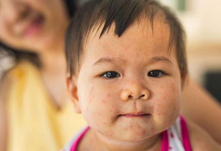 Recurrent Fever in Children - Causes & Tips for Parents