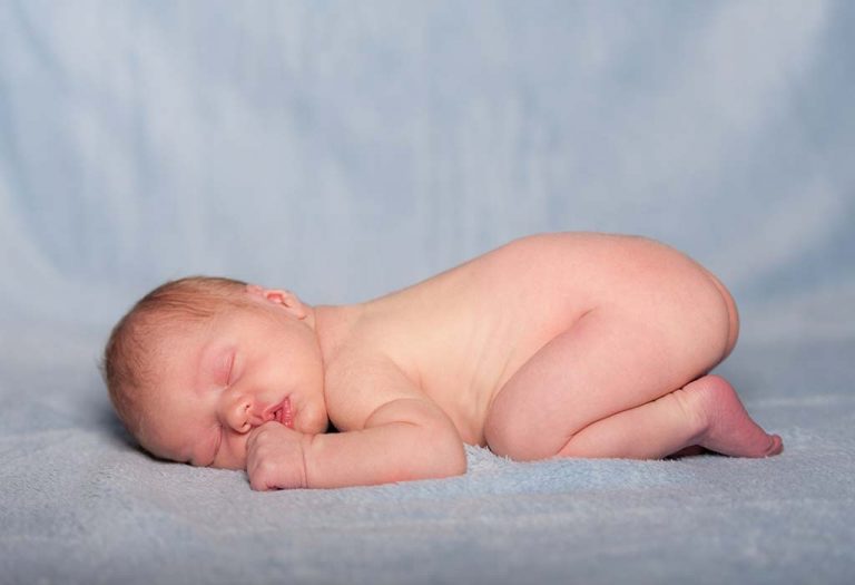 Sacral Dimples - Causes, Symptoms, Diagnosis & Treatment