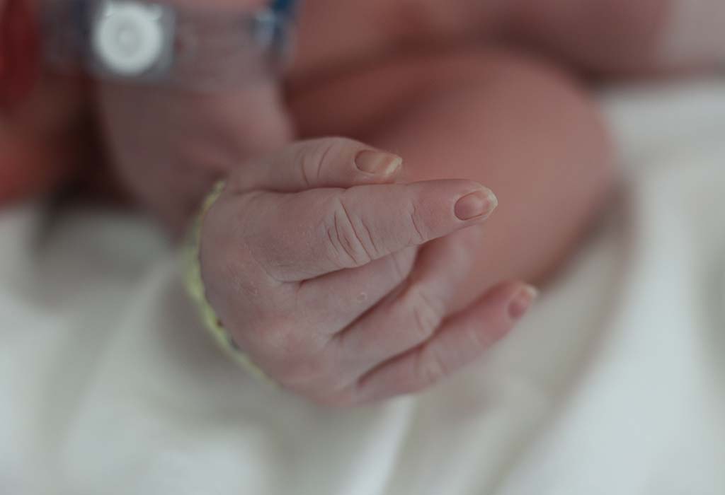 Skin Discoloration in Babies - Causes & Home Remedies