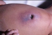 Newborn Belly Button Infection (Omphalitis) - Treatment and Prevention