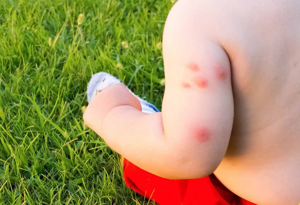 How to Deal with Bed Bug Bites on Babies & Children