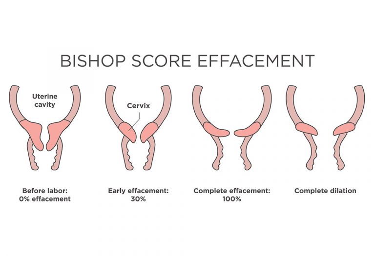 Bishop Score For Labour Induction