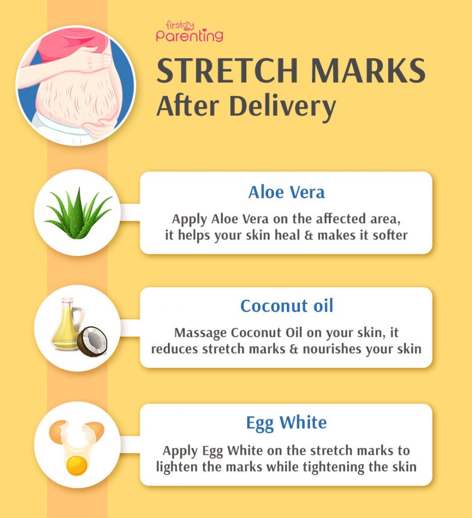 How to Get Rid of Stretch Marks After Childbirth?