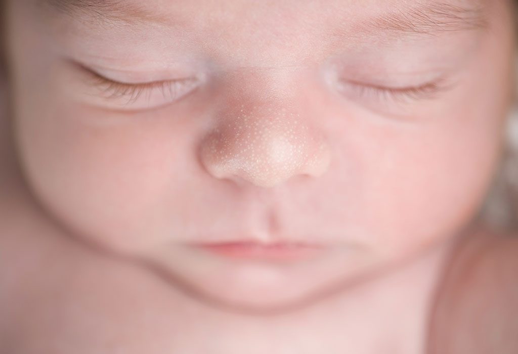 Milium Cyst in Newborn & Infants – Reasons, Signs & Home Remedies