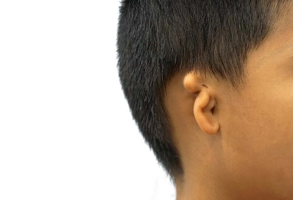 Microtia in Babies: Types, Reasons, Diagnosis & Treatment