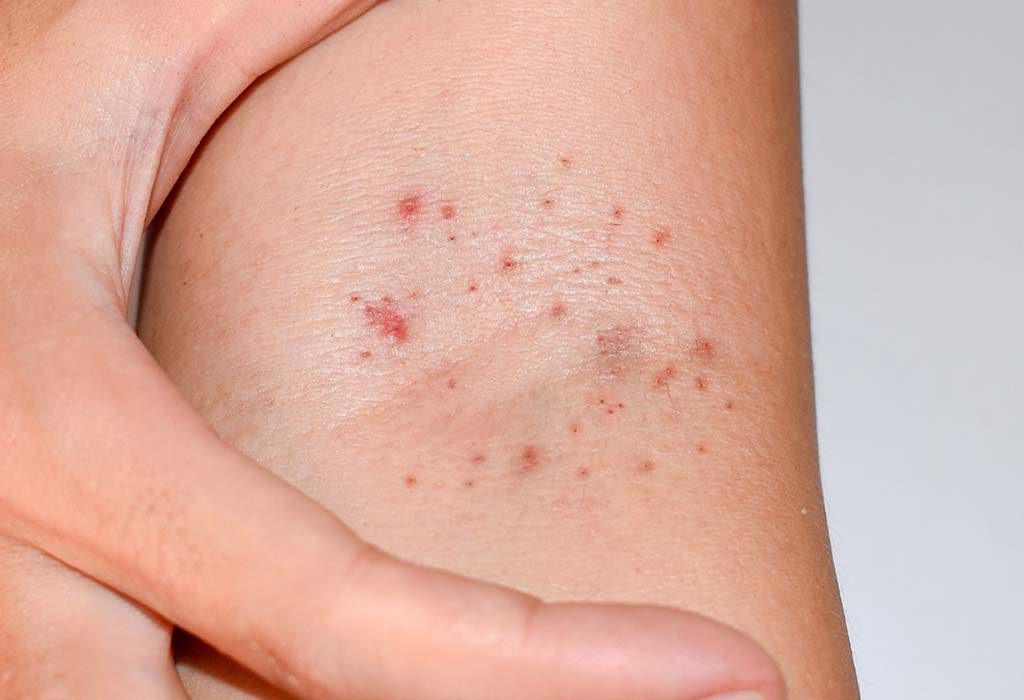 Petechiae in Infants: Causes, Symptoms, Treatment & Prevention