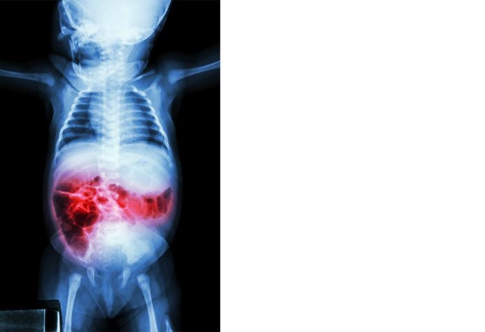 Necrotizing Enterocolitis (NEC) In Babies: Types, Signs & Treatment