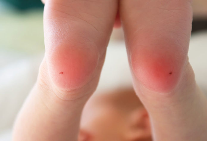 Phenylketonuria (PKU) Screening For Newborn Baby