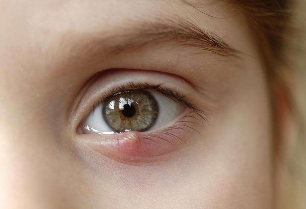 Stye in Child's Eye – Types, Signs, Causes, and Treatment